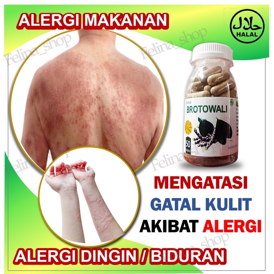 Jual Obat Biduran menahun gatal alergi ampuh tidak kambuh lagi ...
