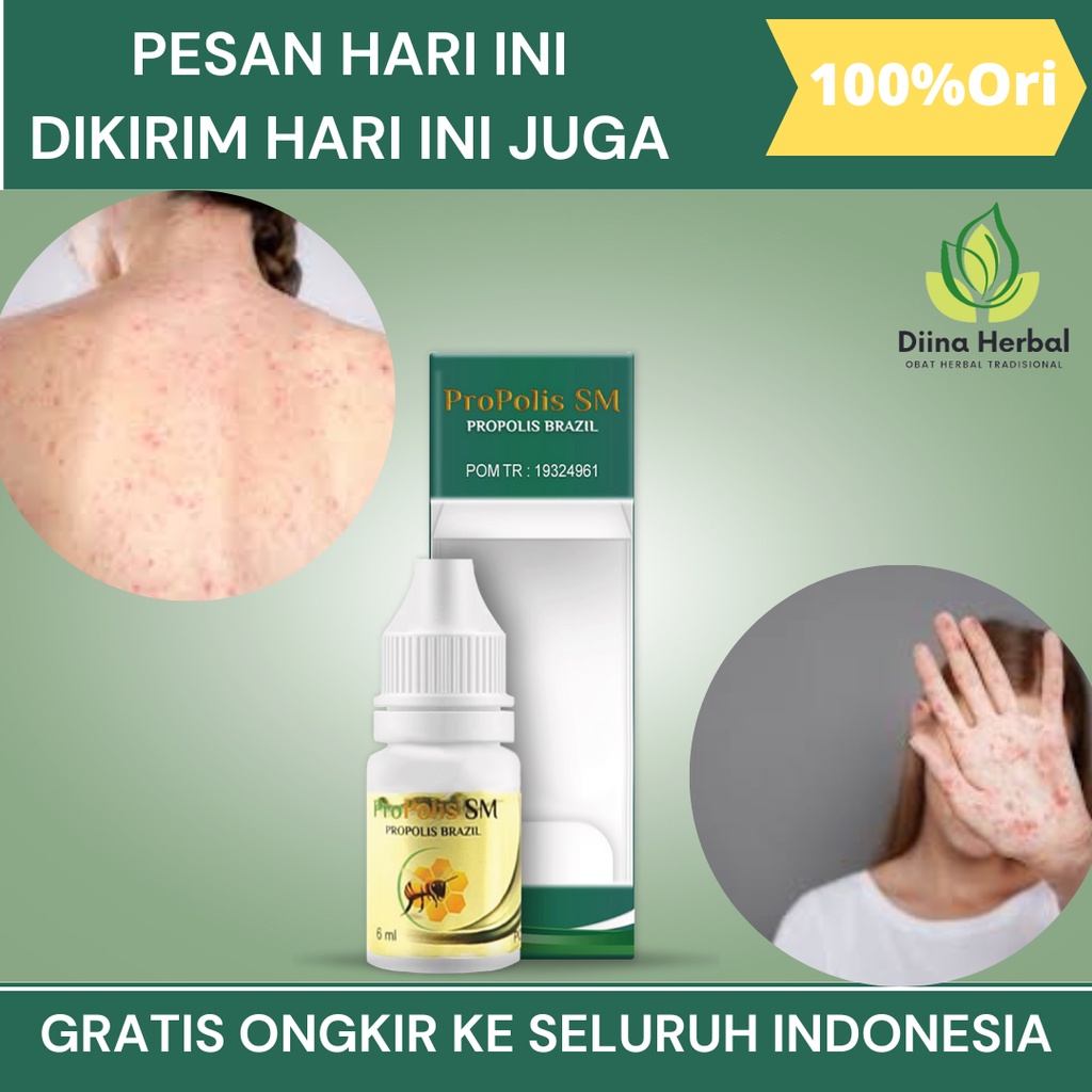 Jual Obat Campak, Obat Penghilang Bekas Campak, Obat Campak Untuk Anak ...