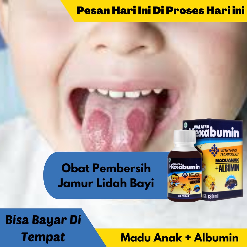 Jual Obat Pembersih Jamur Lidah Bayi , Infeksi Candida Albicans , Lidah ...