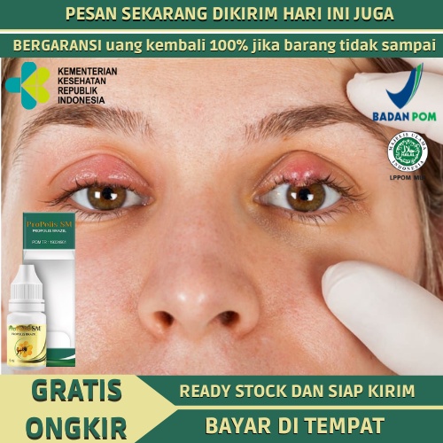 Jual Obat Mata Bintitan, Obat Tetes Mata Bintitan, Obat Mata Bengkak ...