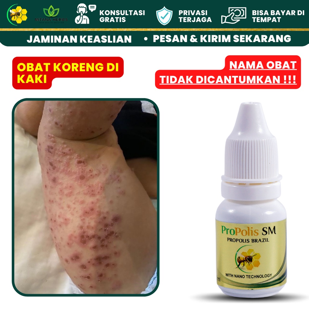 Jual Mitana Herbal - Obat Koreng Di Kaki / Koreng Di Kepala / Koreng ...