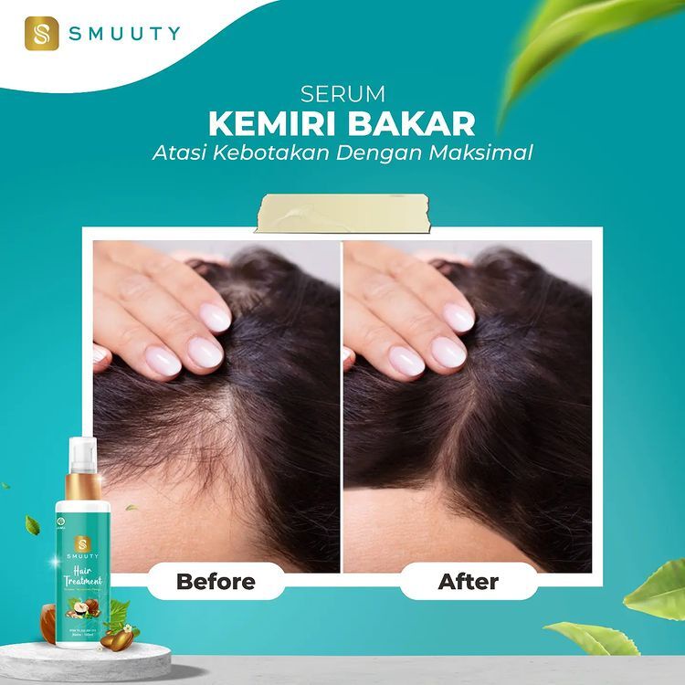 Jual Minyak Kemiri Smuuty Mengatasi Rambut Rontok kebotakan ketombe ...