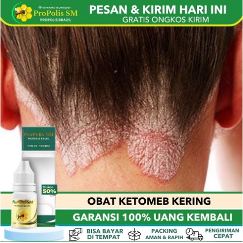 Jual Obat Ketombe Kering, Ketombe Berkerak - Ketombe Akut - Ketombe Parah Rambut Rontok, Obat ...