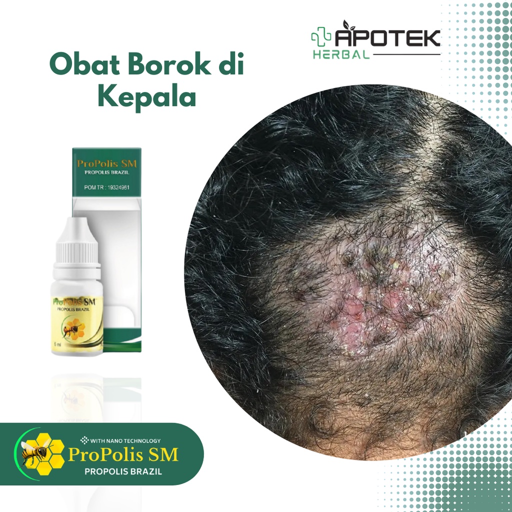 Jual Obat Borok di Kepala, Obat Borok Di Kulit Kepala, Obat Salep Cair Kulit Kepala Borok, Obat ...