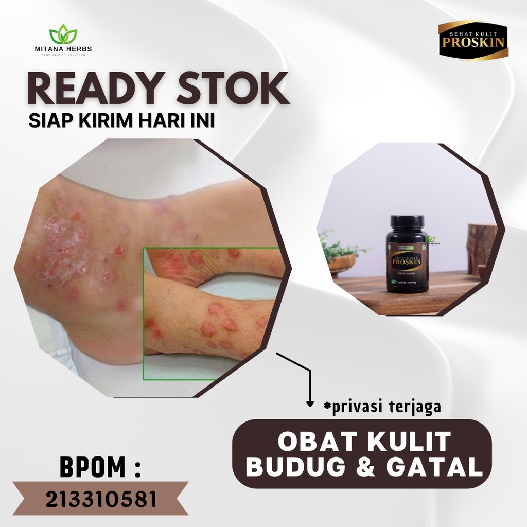 Jual Mitana Herbal - Obat Budug - Obat Scabies Manusia - Obat Koreng ...