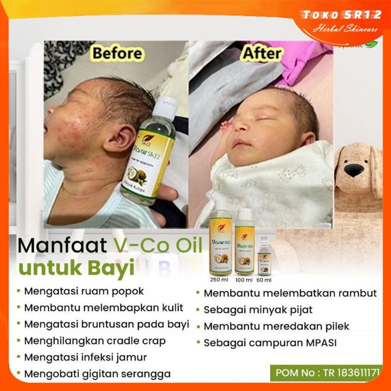 Jual Obat Ruam Popok Ruam Asi Biang Keringat Gatal-Gatal Bayi / Vco ...