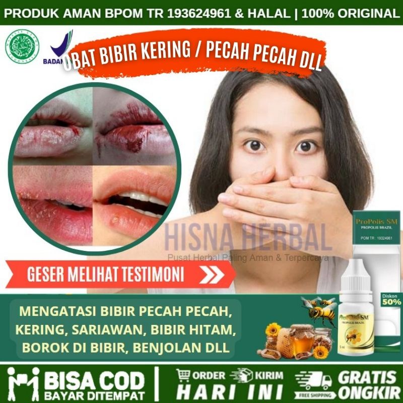 Jual Obat Penghilang Bintik Putih di Bibir / Fordyce Spots, Bibir Pecah ...