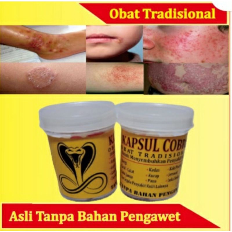 Jual Kapsul Ular Cobra 20 Kapsul/Obat Gatal/Obat Eksim/Obat Jerawat/Obat Alergi Dan Penyakit ...