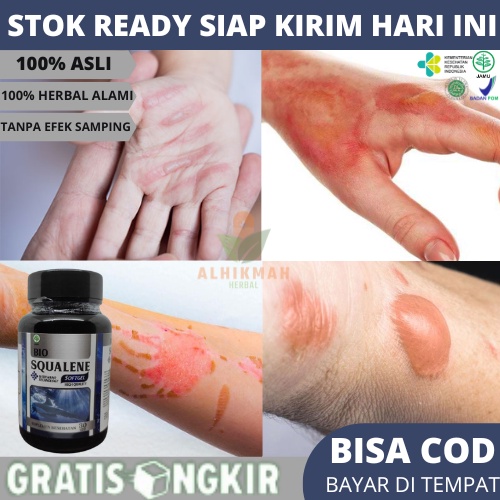 Jual Obat Luka Bakar, Obat Pengering Luka Bakar, Obat Mempercepat ...