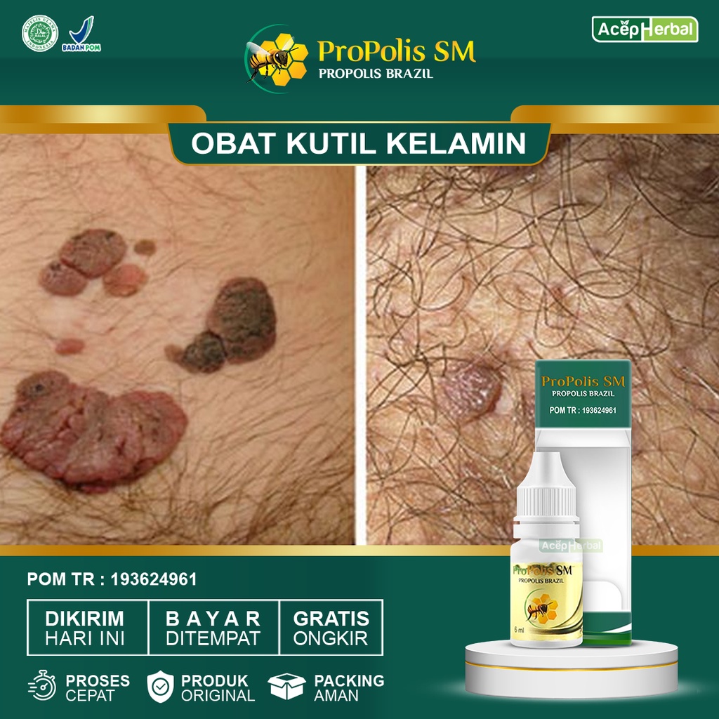 Jual Obat Tetes Kutil Kelamin Daging Jadi Skin Tag Benjolan Di Miss V ...