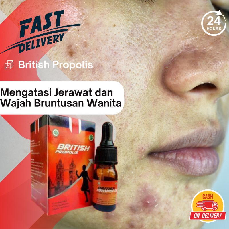 Jual British Propolis 6ml Obat Herbal Jerawat Wanita Punggung Batu ...