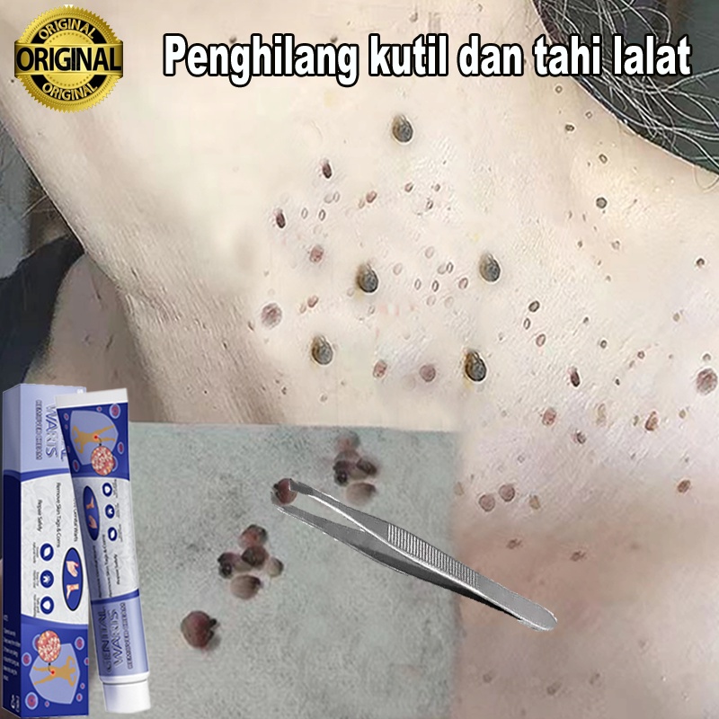 Jual Obat Penghilang Kutil Dan Tahi Lalat Skin Tag Remover Obat Kutil ...