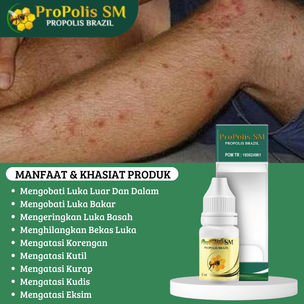 Jual Obat Penghilang Bekas Luka Kulit Korengan Kurap, Kudis Eksim Kutil ...