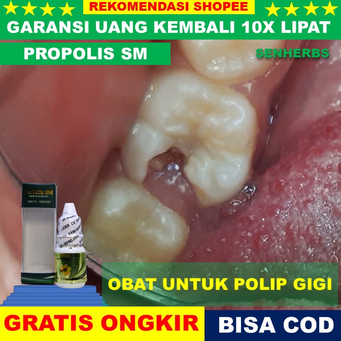 Jual obat polip gigi Obat Polip Gigi, Obat Polip Pulpa, Obat Abses Gigi ...