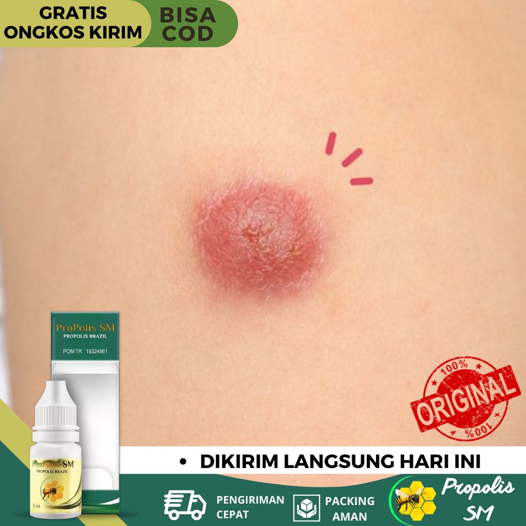 Jual Obat Bisul, Obat Bisulan Di Tubuh, Obat Bisul Bernanah, Obat Bisul ...