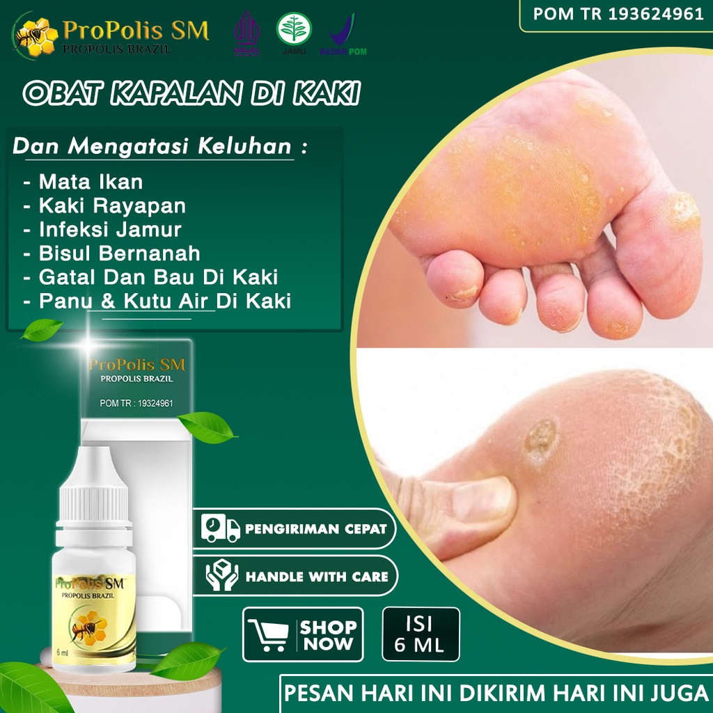 Jual Obat Oles Kapalan Di Kaki Dan Tangan Penghilang Mata Ikan Pada ...