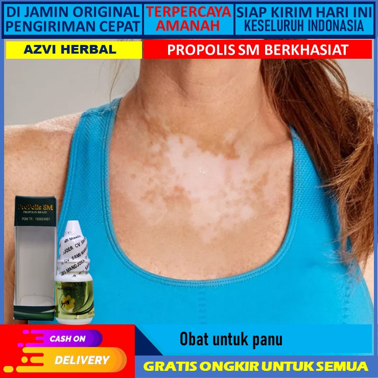 Jual obat panu Obat Panu Herbal Alami Obat Jamur Kulit Panu Propolis SM ...