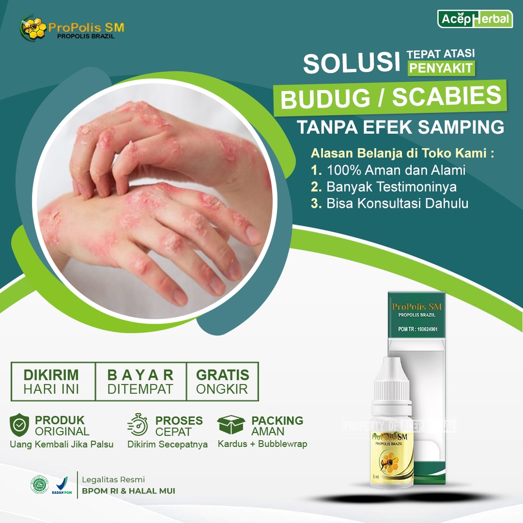 Jual Obat Budug Scabies Kudis Eksim Gatal Ruam Kulit Bintik Bintik Luka ...