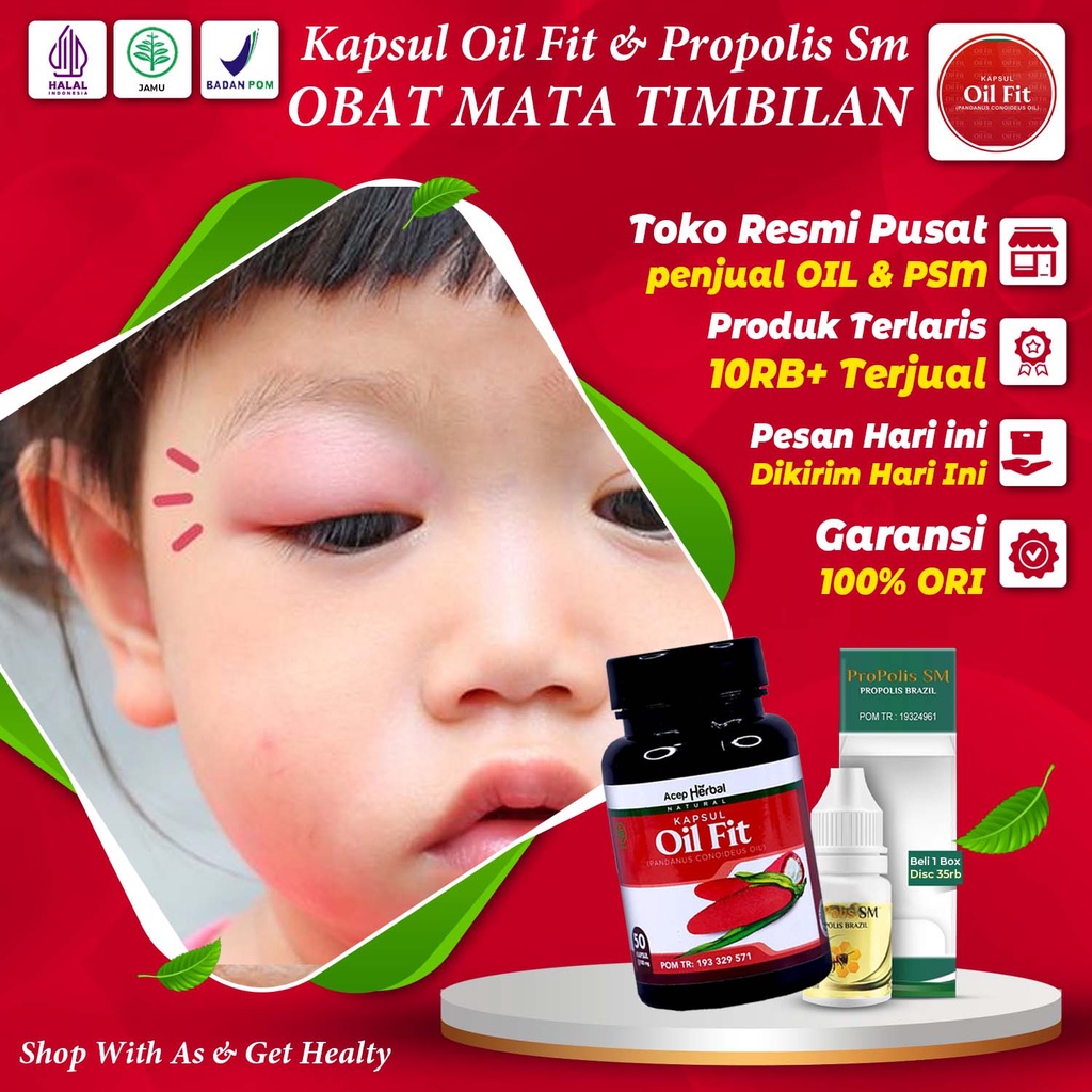 Jual Obat Benjolan Di Kelopak Mata Timbilan Mata Bintitan Kalazion ...