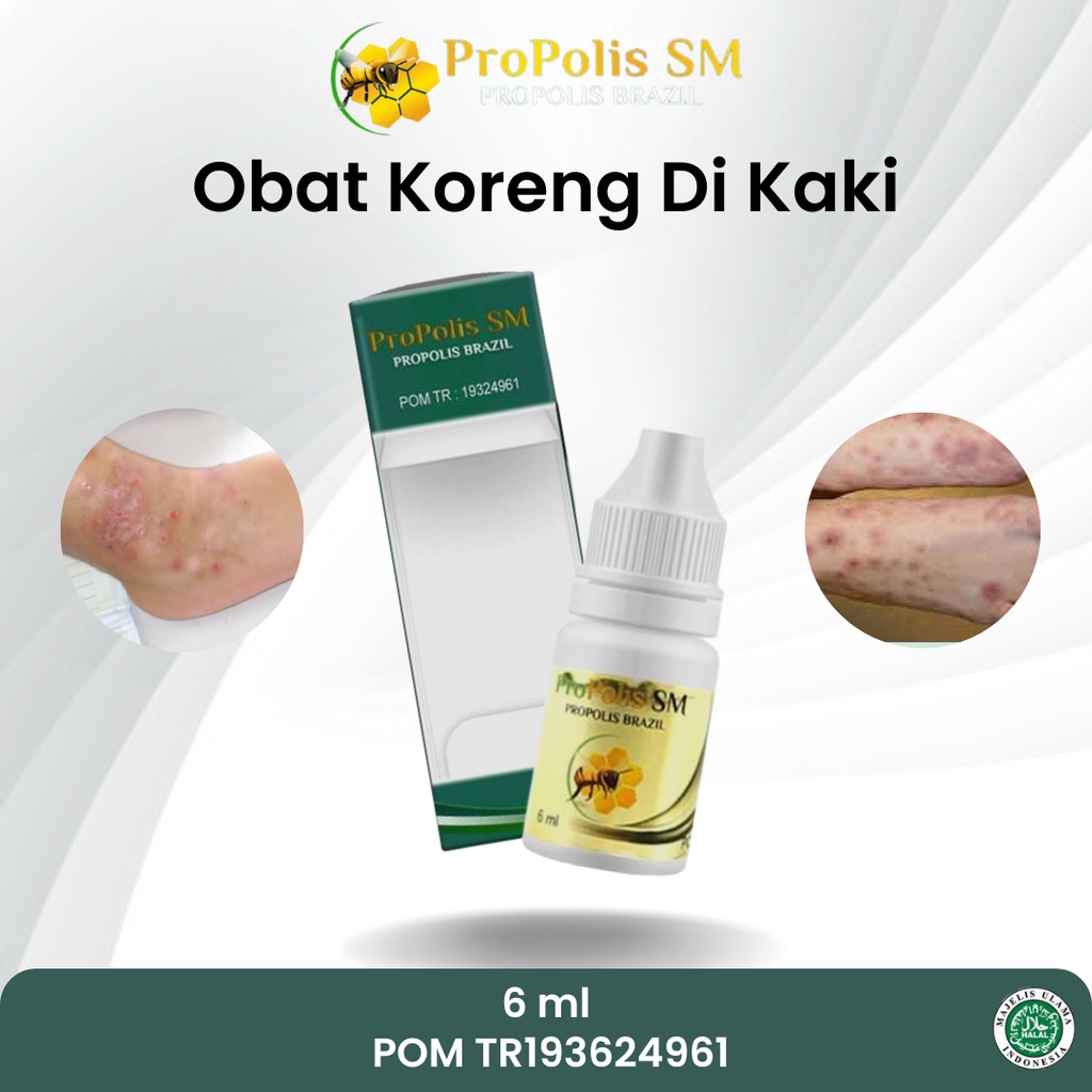 Jual Obat Koreng Di Kaki Salep Korengan Koreng Gatal Luka Robek Luka ...