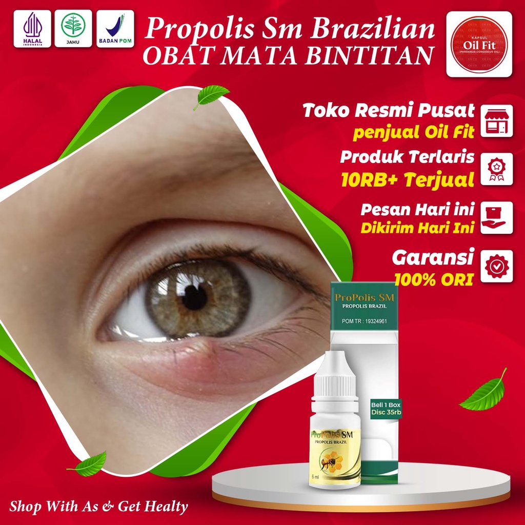 Jual Obat Mata Bintitan Luar Mata Kalazion Anak dan Dewasa Benjolan Di ...