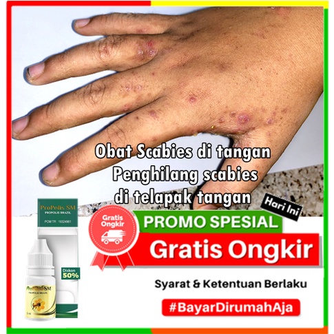 Jual Obat Scabies di tangan, Penghilang scabies di telapak tangan ...