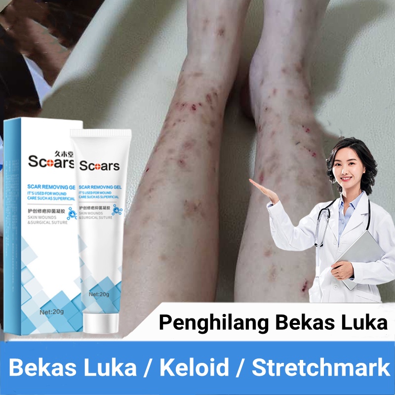 Jual Penghilang Bekas Luka Salep Bekas Luka Keloid Kelocote Anti Scar ...