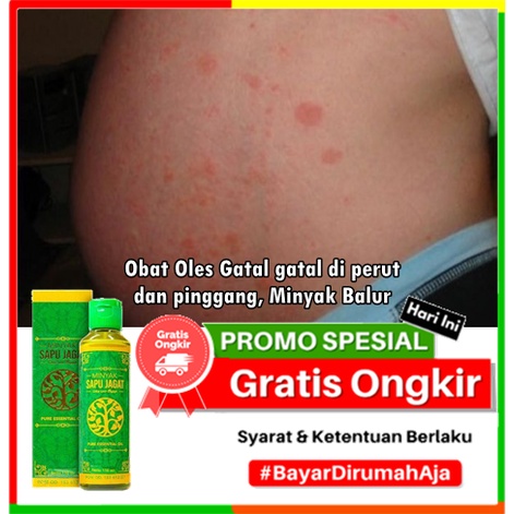 Jual Obat Oles Gatal gatal di perut dan pinggang, Minyak Balur ...