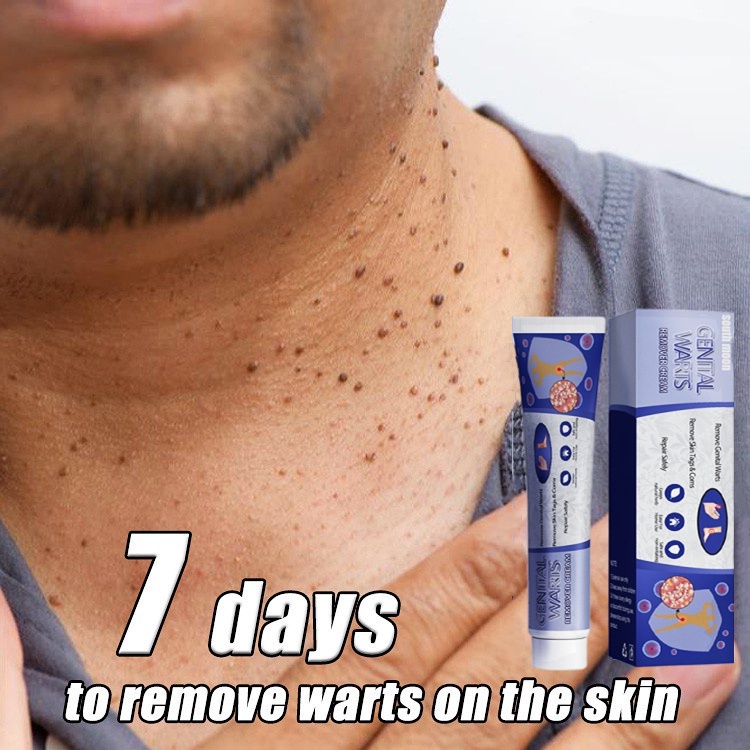 Jual skin tag remover original salep penghilang tahi lalat obat ...